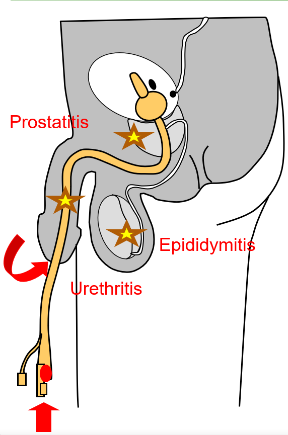 Harnröhrenkatheter (Dauerkatheter, Einmalkatheter) | Urologie Amriswil