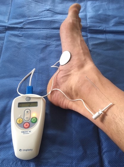 PTNS | Urologie Amriswil